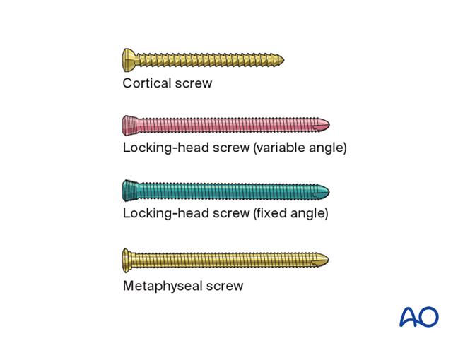 Medial plating