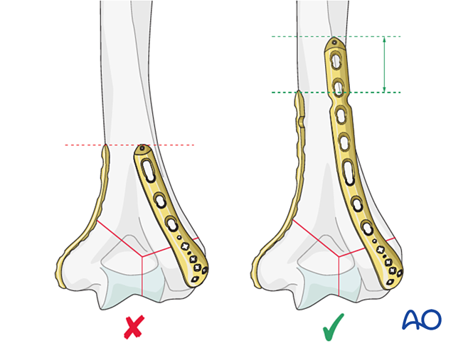 Dorsolateral plating