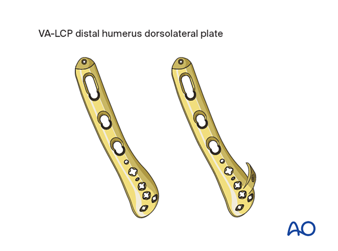 Dorsolateral plating