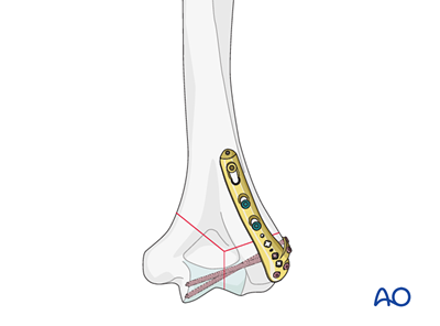 Dorsolateral plating