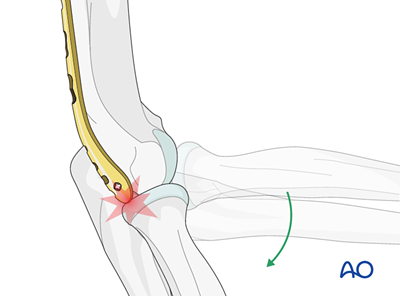 Dorsolateral plating