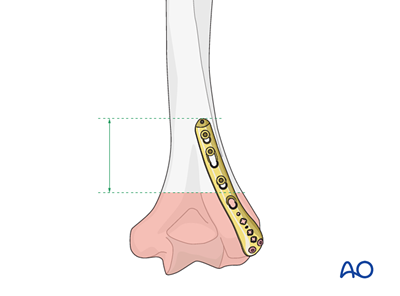 Dorsolateral plating