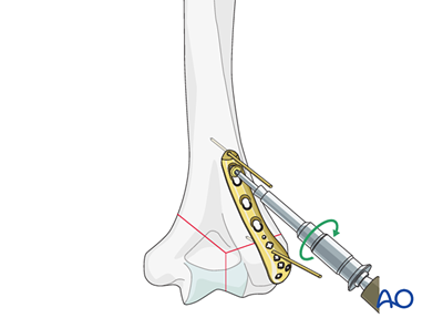 Dorsolateral plating