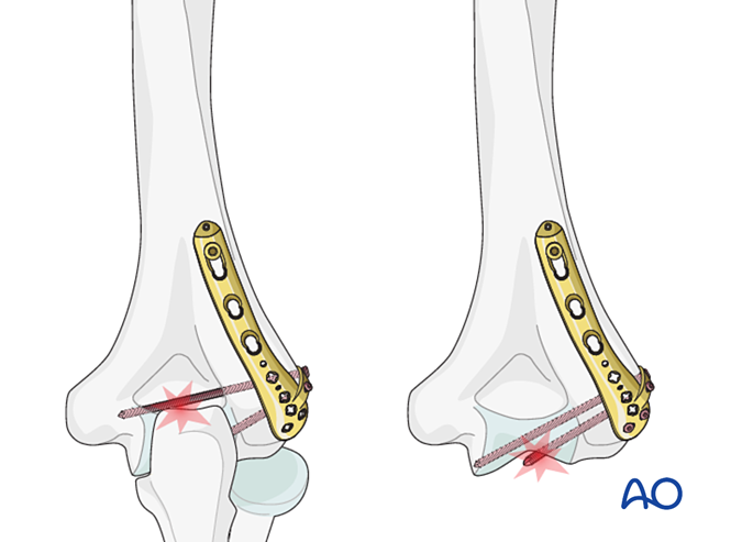 Dorsolateral plating