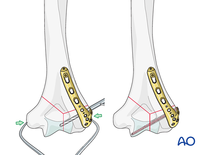 Dorsolateral plating