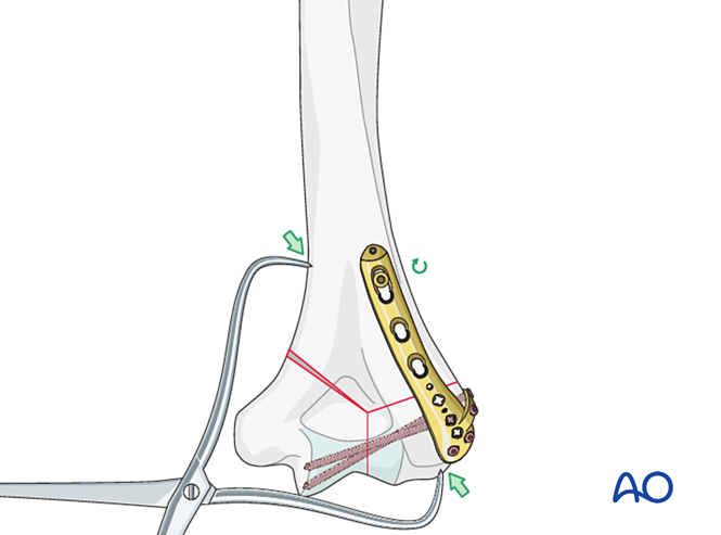 Dorsolateral plating