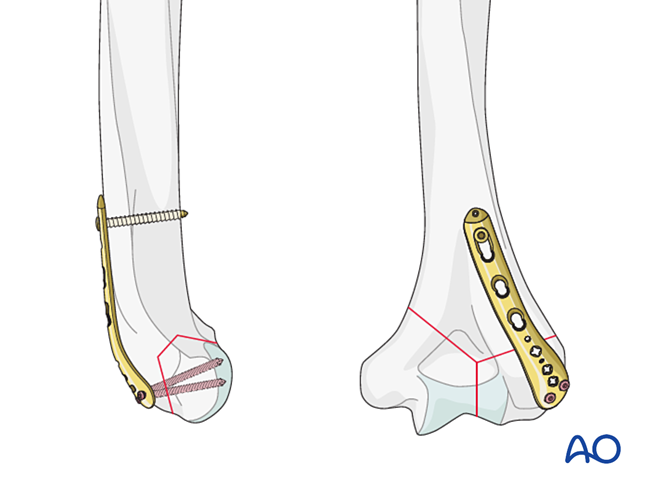 Dorsolateral plating