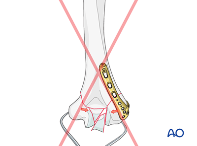 Dorsolateral plating