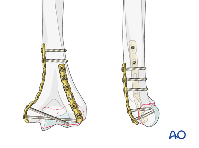 Reconstruction plates