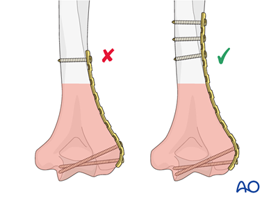 Reconstruction plates