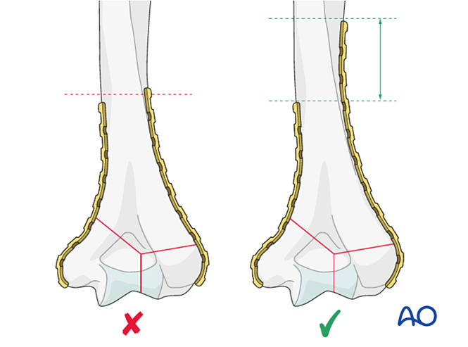 Reconstruction plates