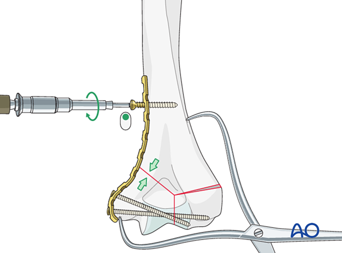 Reconstruction plates