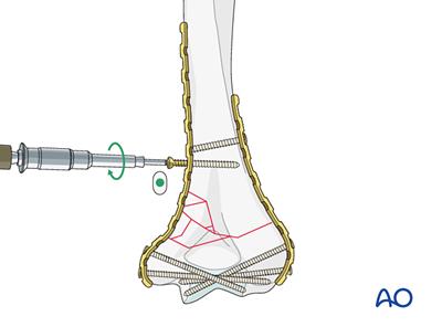 Reconstruction plates