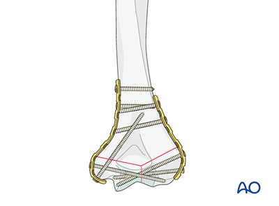 Reconstruction plates