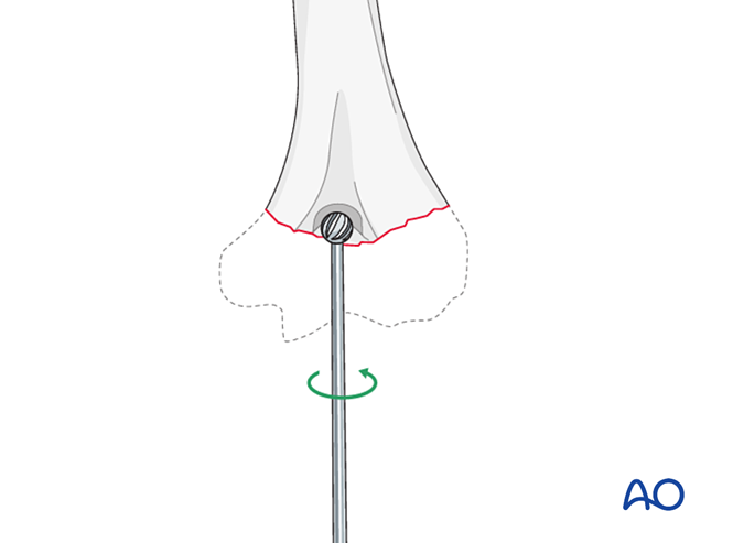 Total elbow arthroplasty