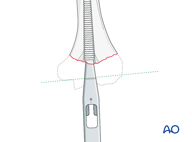 Total elbow arthroplasty