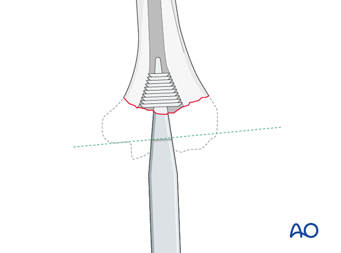 Total elbow arthroplasty