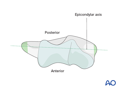 Hemiarthroplasty