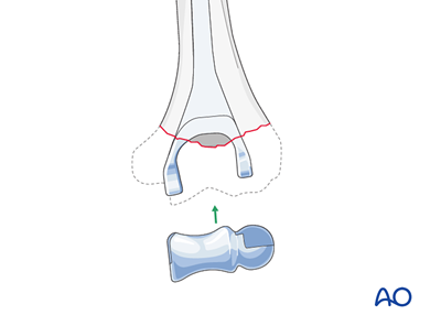 Total elbow arthroplasty