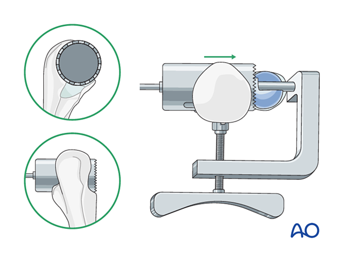 Total elbow arthroplasty