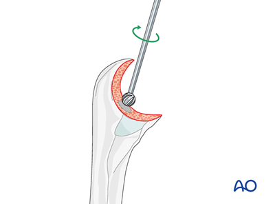 Total elbow arthroplasty