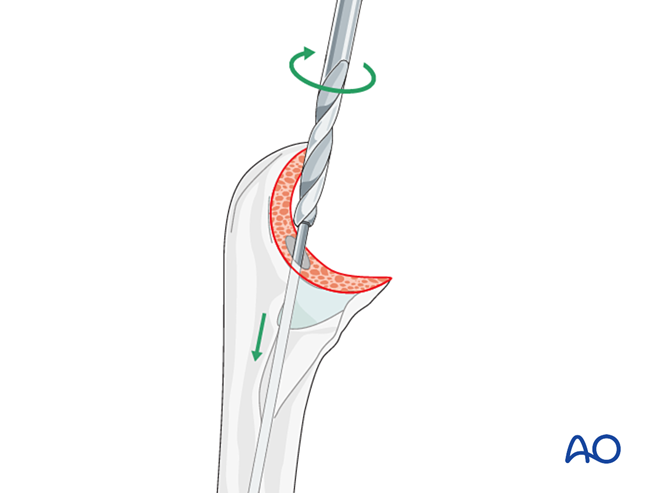 Total elbow arthroplasty