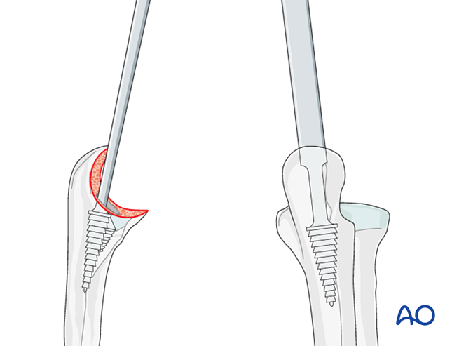 Total elbow arthroplasty
