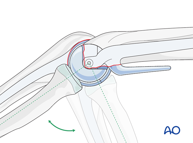 Total elbow arthroplasty