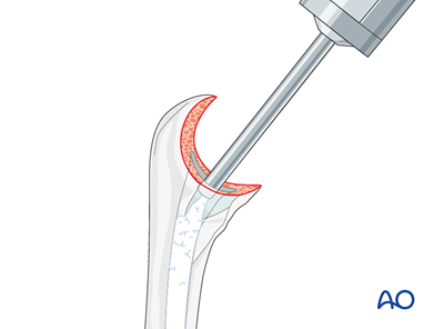 Total elbow arthroplasty