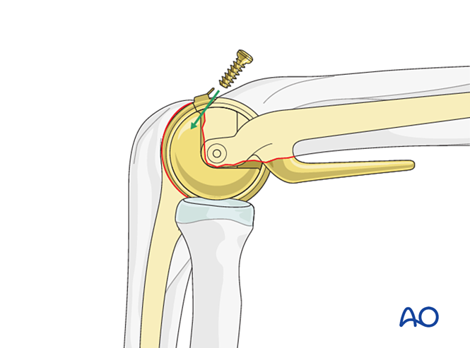 Total elbow arthroplasty