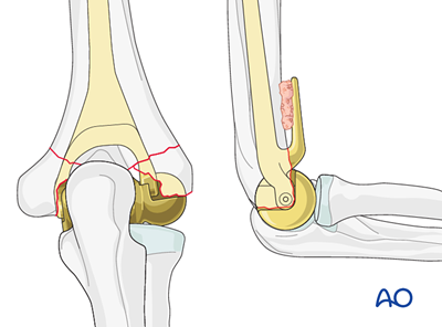 Hemiarthroplasty
