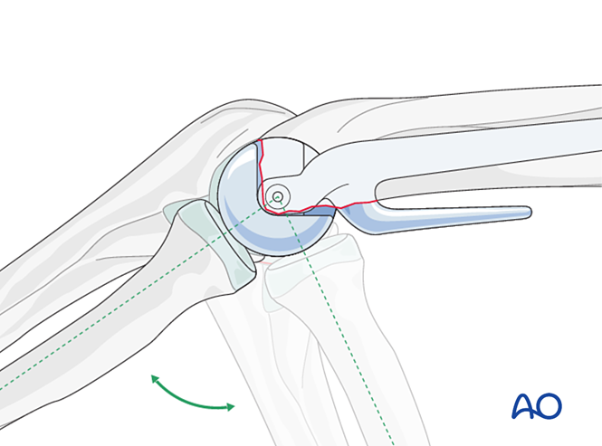 Hemiarthroplasty