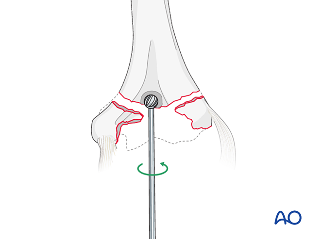 Hemiarthroplasty