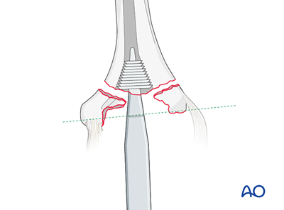 Hemiarthroplasty
