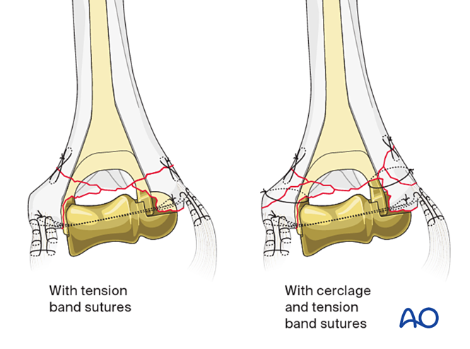 Hemiarthroplasty