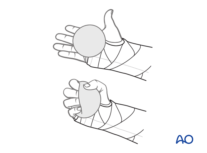 Splint immobilization for Avulsion of medial epicondyle