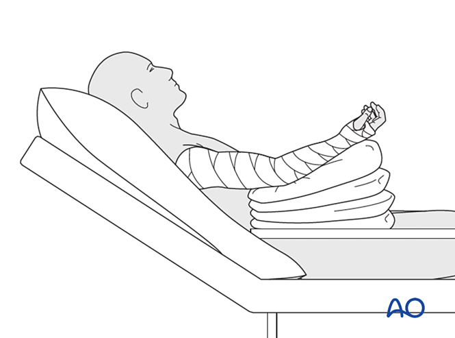 ORIF - Plate fixation for Complete articular fracture, simple articular ...