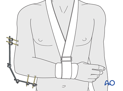 External fixation for Extraarticular, simple oblique fracture