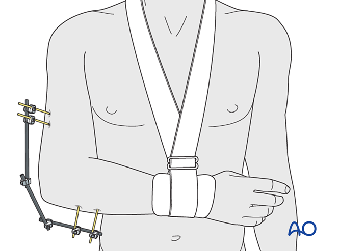 External fixation for preliminary treatment for Complete articular ...