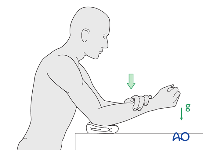 ORIF - Plate fixation for Complete and multifragmentary articular fracture