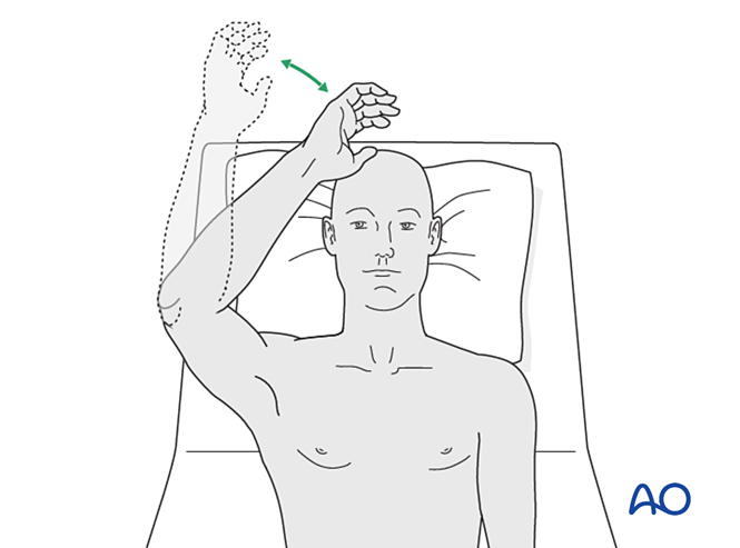 Splint immobilization for Complete articular fracture, simple articular ...