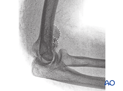 Partial articular fracture in frontal/coronal plane