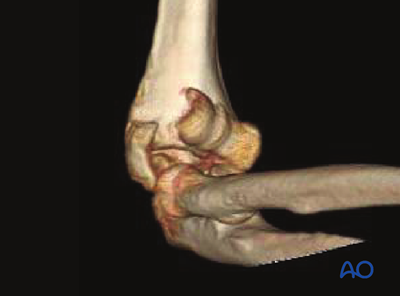 Partial articular fracture in frontal/coronal plane