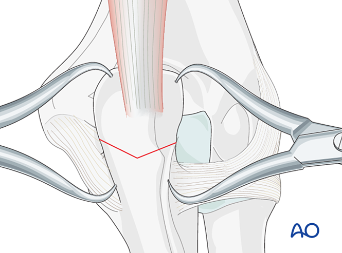 Plate fixation of olecranon osteotomy