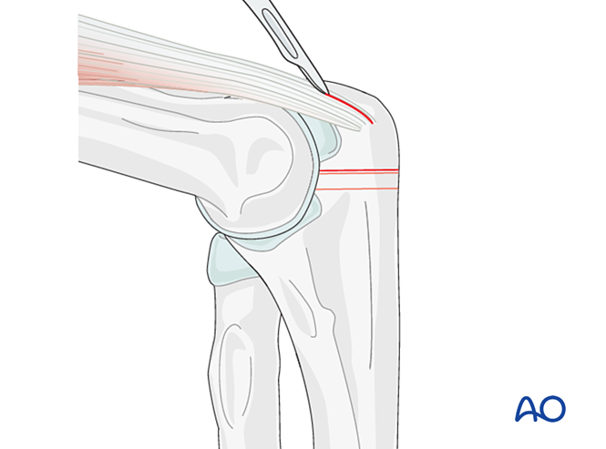Plate fixation of olecranon osteotomy