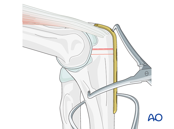 Plate fixation of olecranon osteotomy