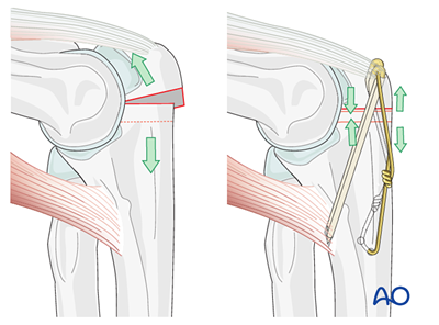Tension band fixation of olecranon osteotomy
