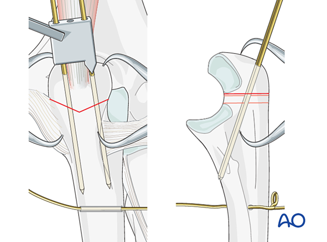 Tension band fixation of olecranon osteotomy