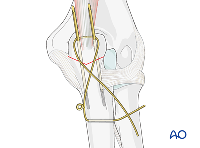 Tension band fixation of olecranon osteotomy