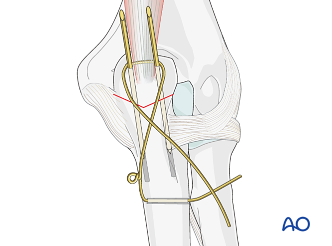 Tension band fixation of olecranon osteotomy